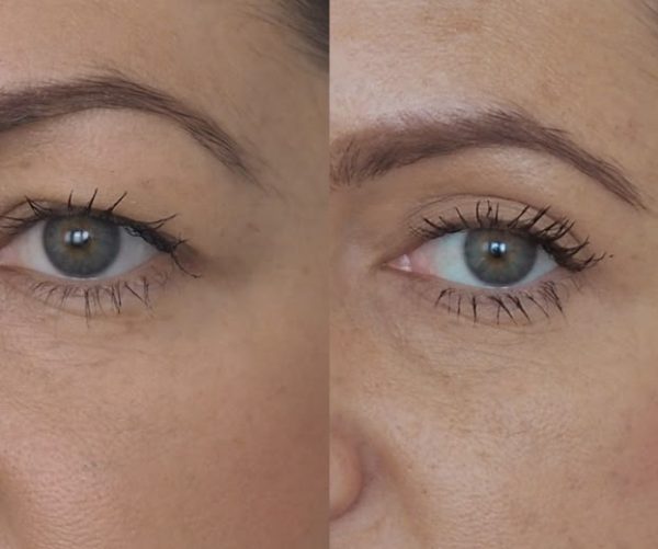 Orbit and Oculoplasty - Prasad Eye Care Centre