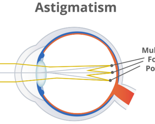 Refractive(Laser) Surgeries - Prasad Eye Care Centre
